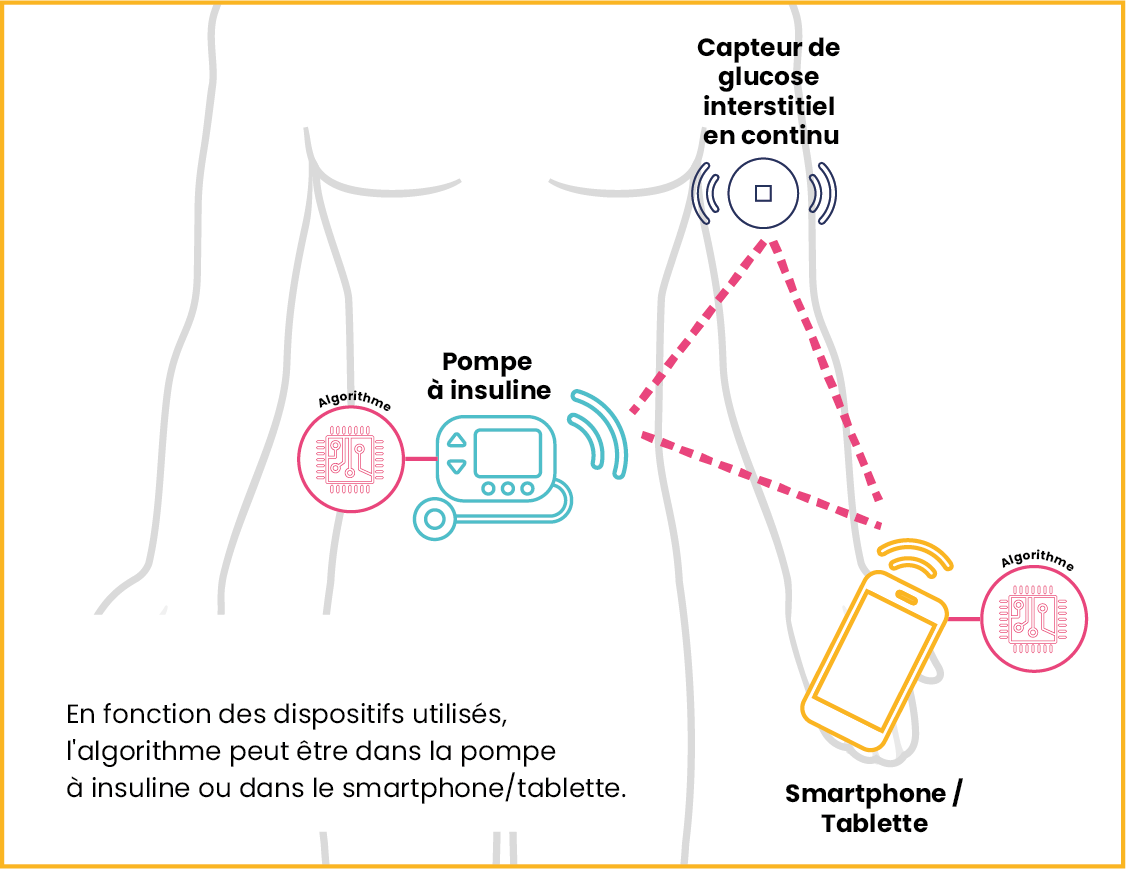 La boucle fermée - ISIS DIABÈTE